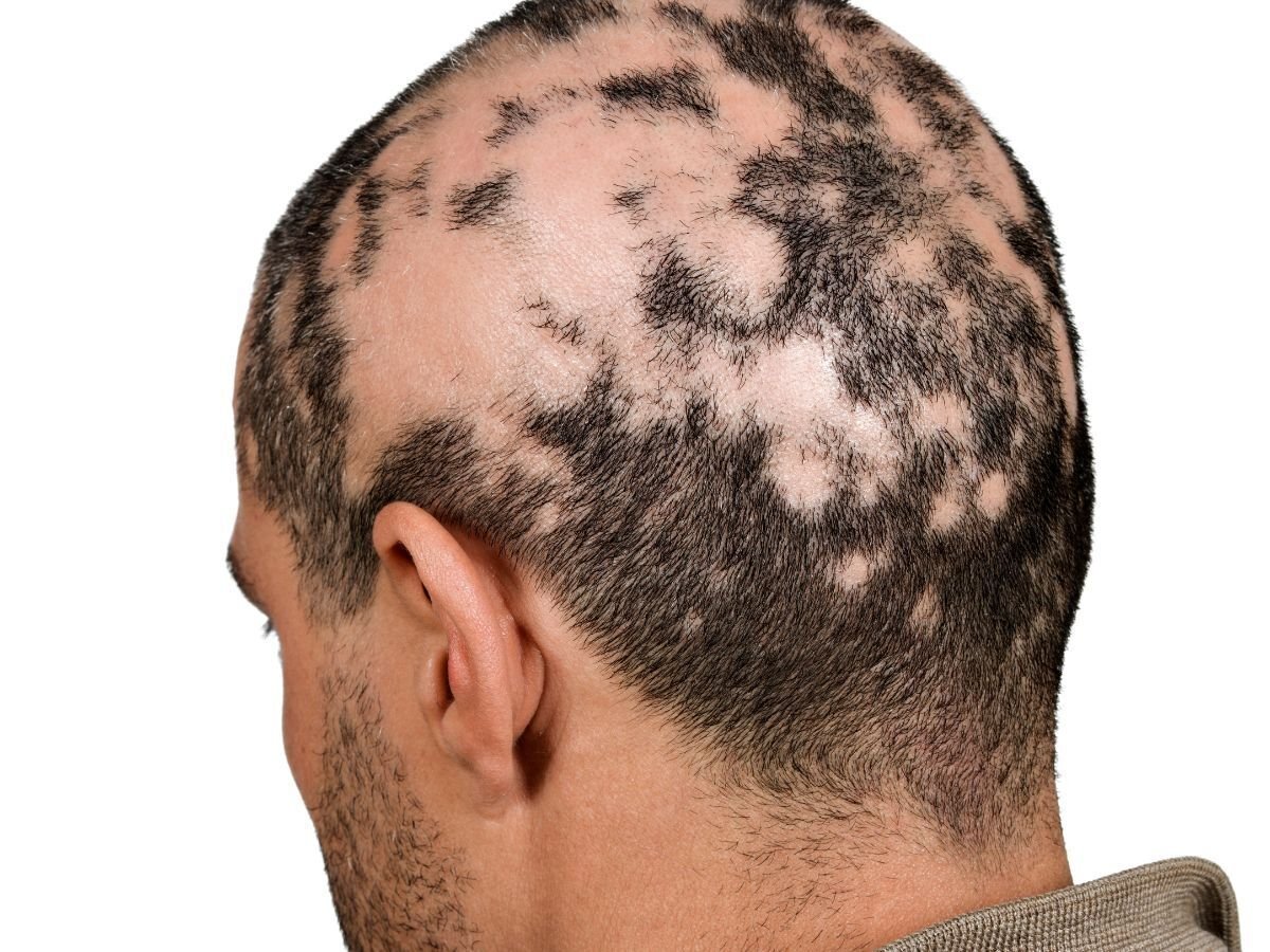 Hair Loss Treatment In Melaka | Klinik Liysha Bukit Rambai